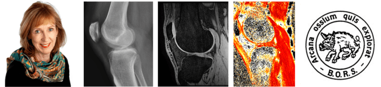 BORS Public Lecture – Professor Fiona Gilbert – British Orthopaedic ...